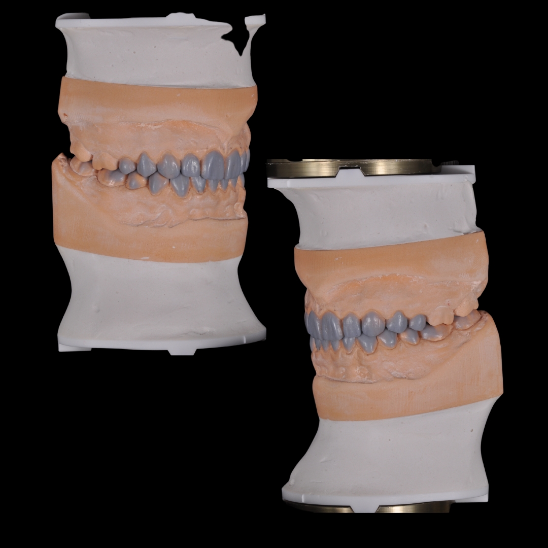 Odbudowa zębów - Bonding - SmileCraft Warszawa